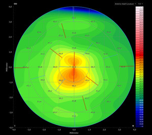 New cataract and refractive imaging platform unveiled | Heidelberg ...