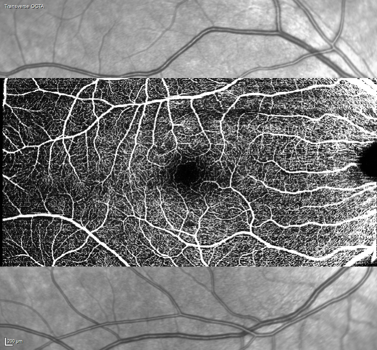SPECTRALIS OCT Angiography Module update | Heidelberg Engineering Ltd.